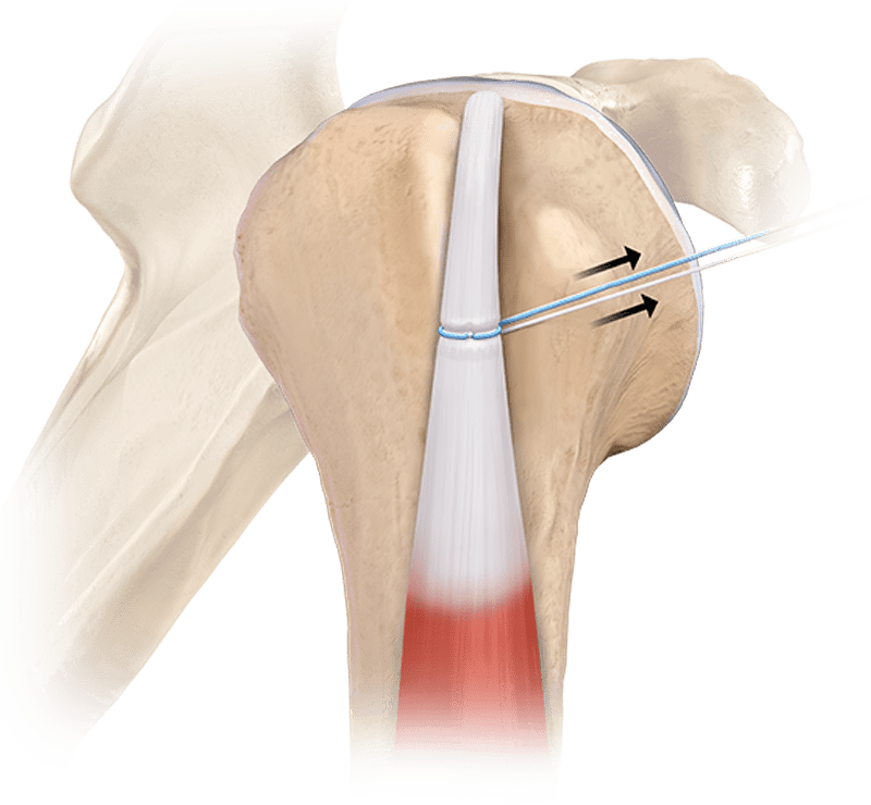 Arthrex - Knotless FiberTak® Biceps Tenodesis