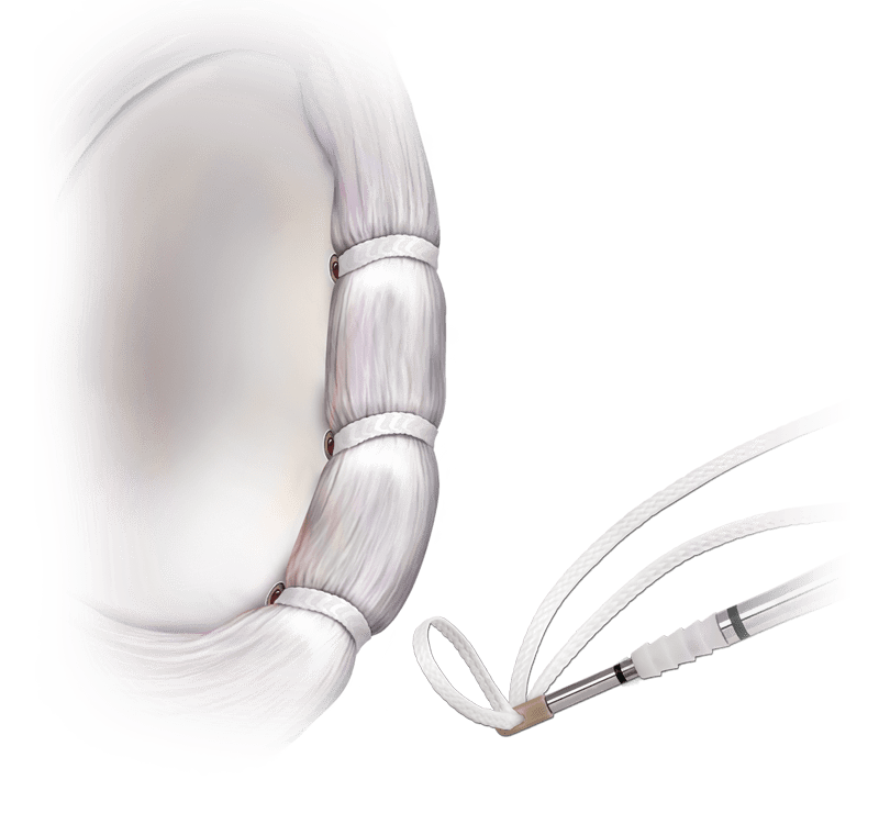 Arthrex - PushLock® Anchor