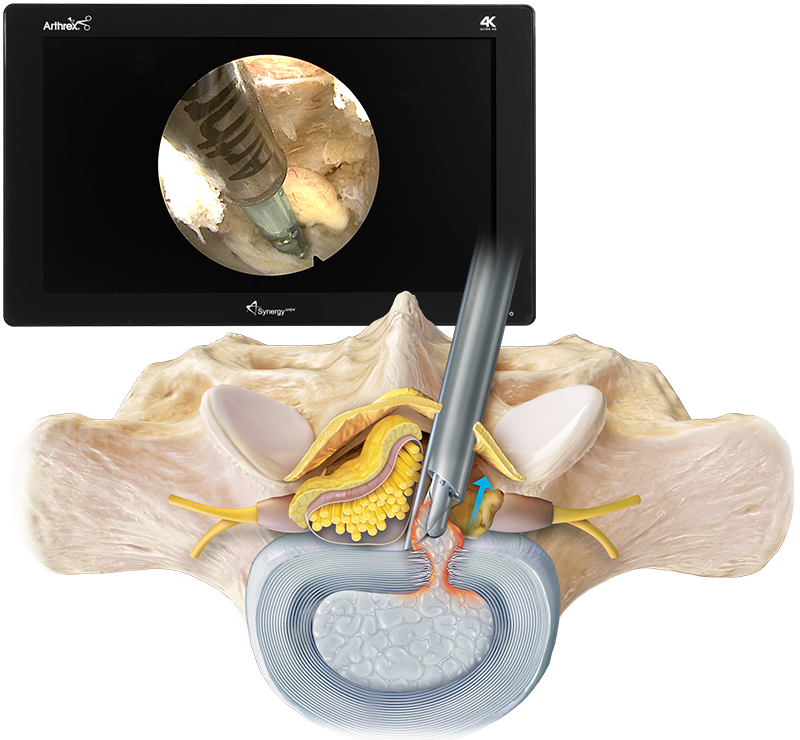 Arthrex - Interlaminar Endoscopic Discectomy