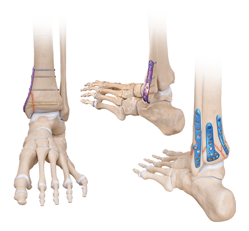 Arthrex - Titanium Ankle Fracture System
