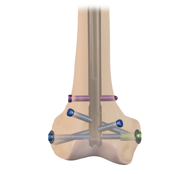 Arthrex - Retrograde Femoral Nail System