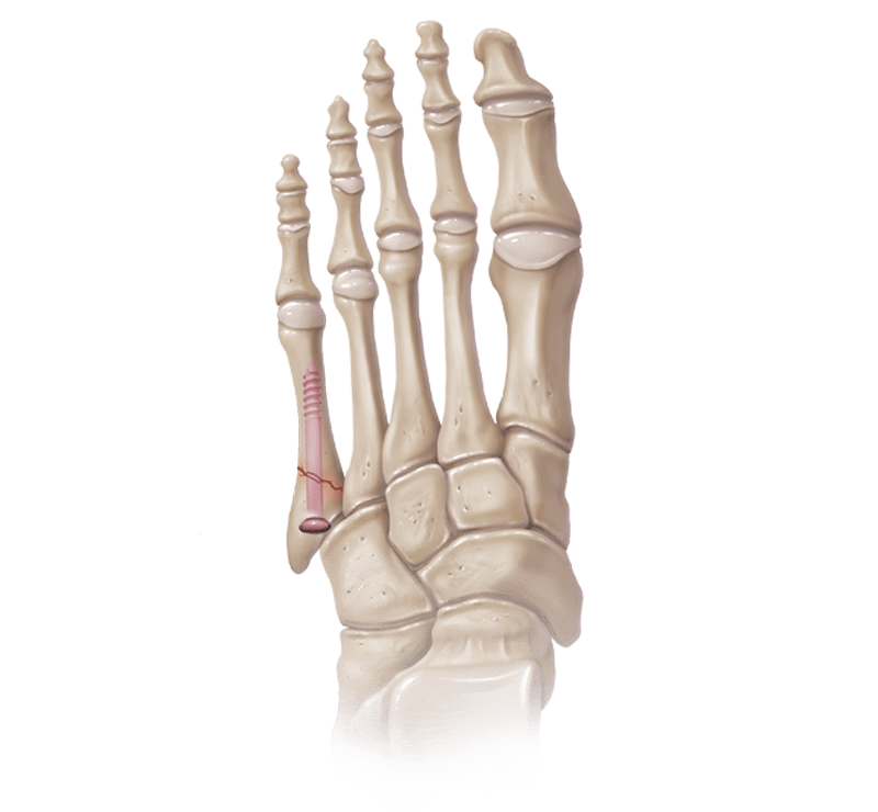 Arthrex - Jones Fracture Repair