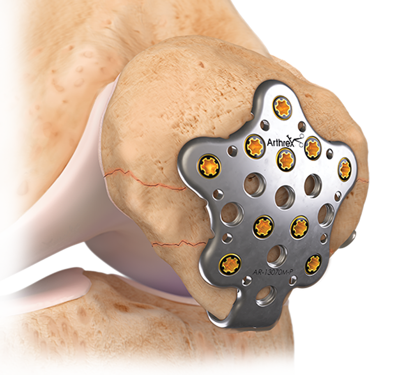 Arthrex - Patella SuturePlate™ II