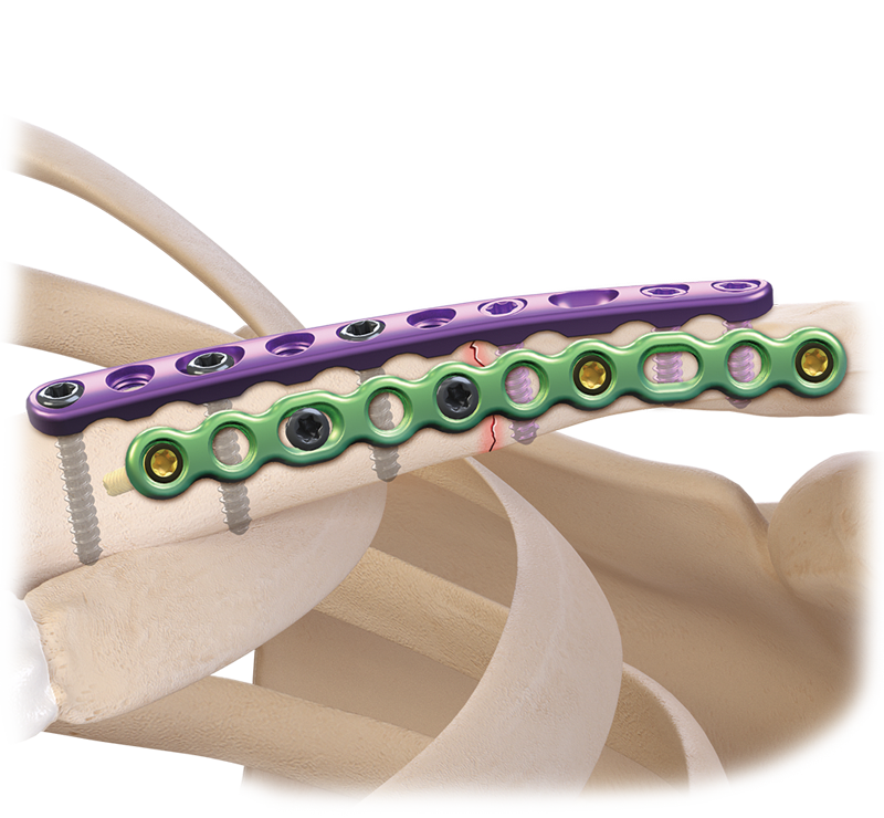 Arthrex - Mini Fragment System 2.0 mm/2.4 mm/2.7 mm