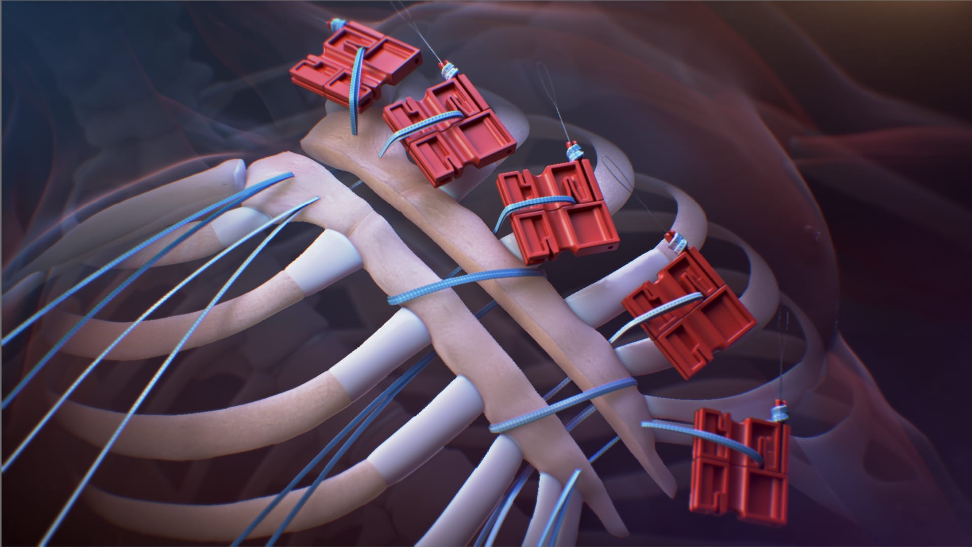 Arthrex - FiberTape® Sternal Closure System