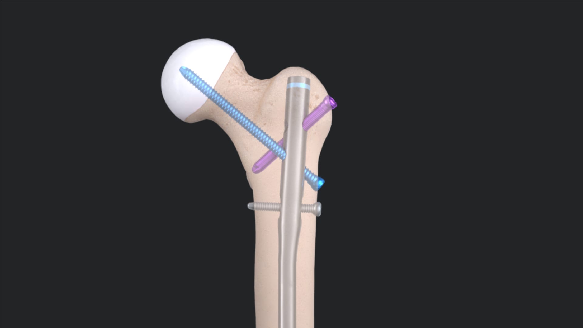 Arthrex - Retrograde Femoral Nail System