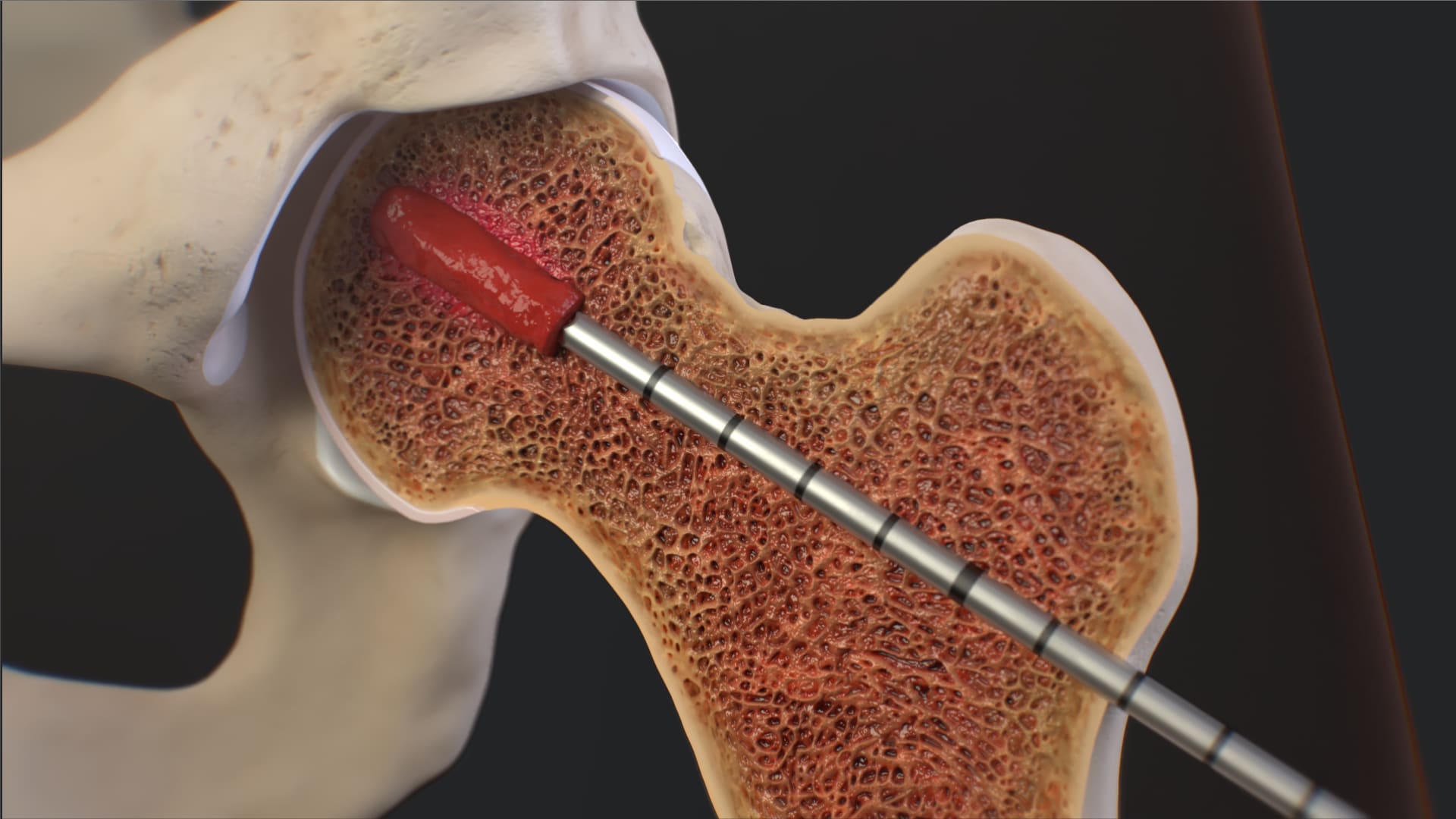 Arthrex - IntraOsseous BioPlasty® (IOBP) Technique