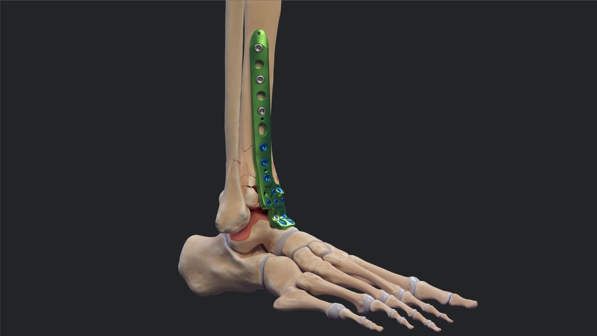 Arthrex - Pilon Fusion Plating System