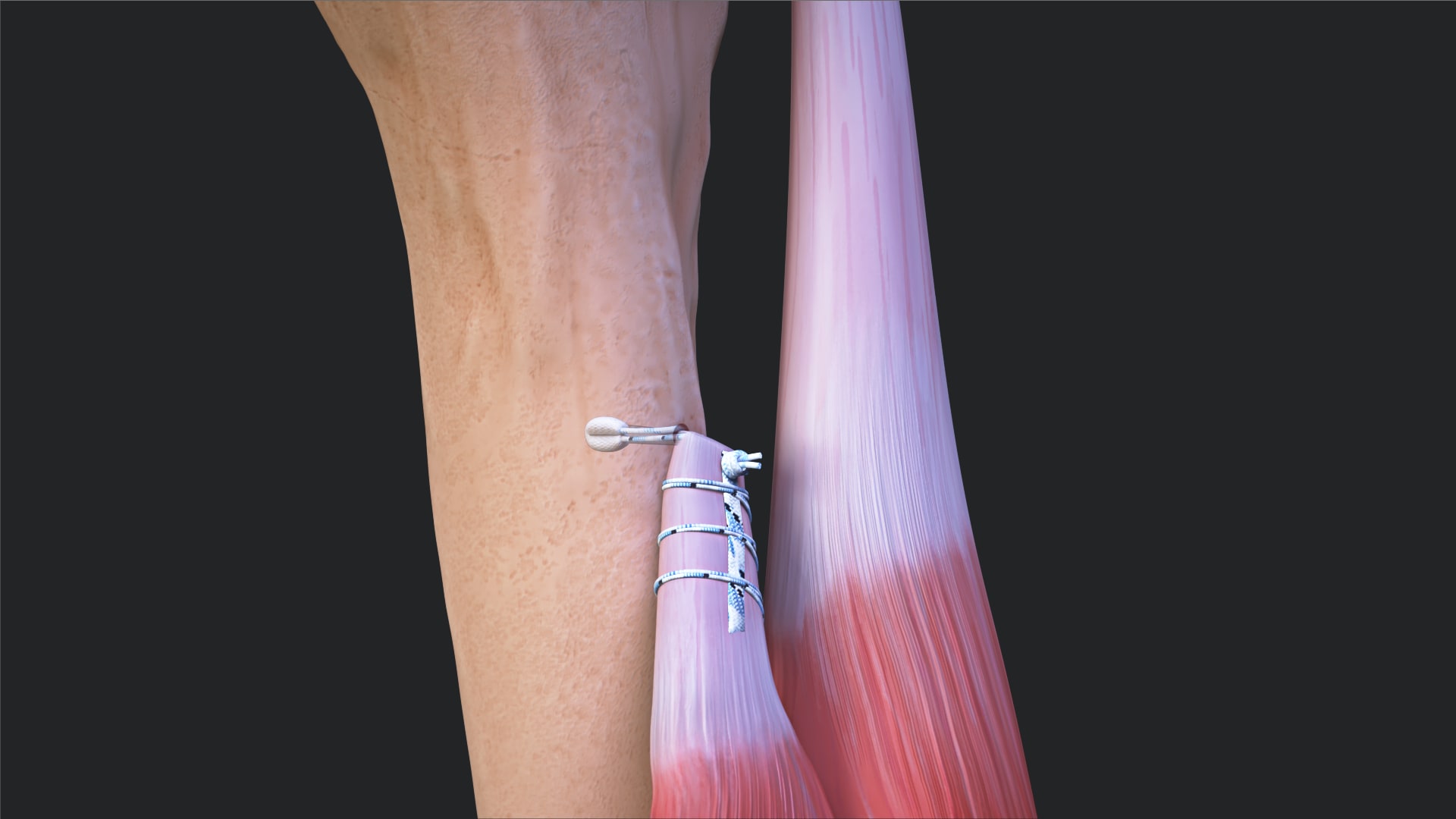 Arthrex - SutureTag Suture