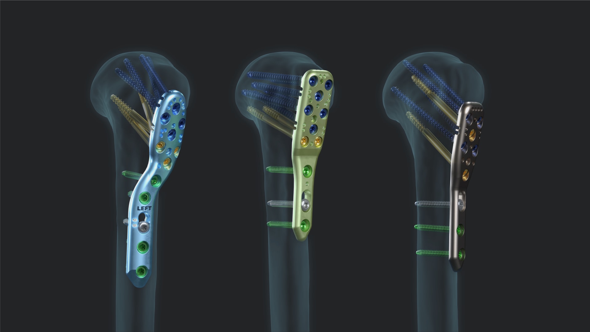 Arthrex - Proximal Humerus Plating System