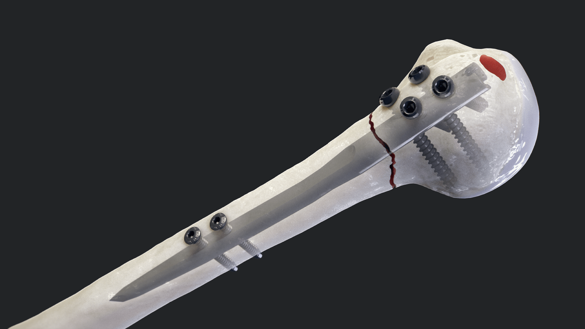 Arthrex - Humeral Nail System