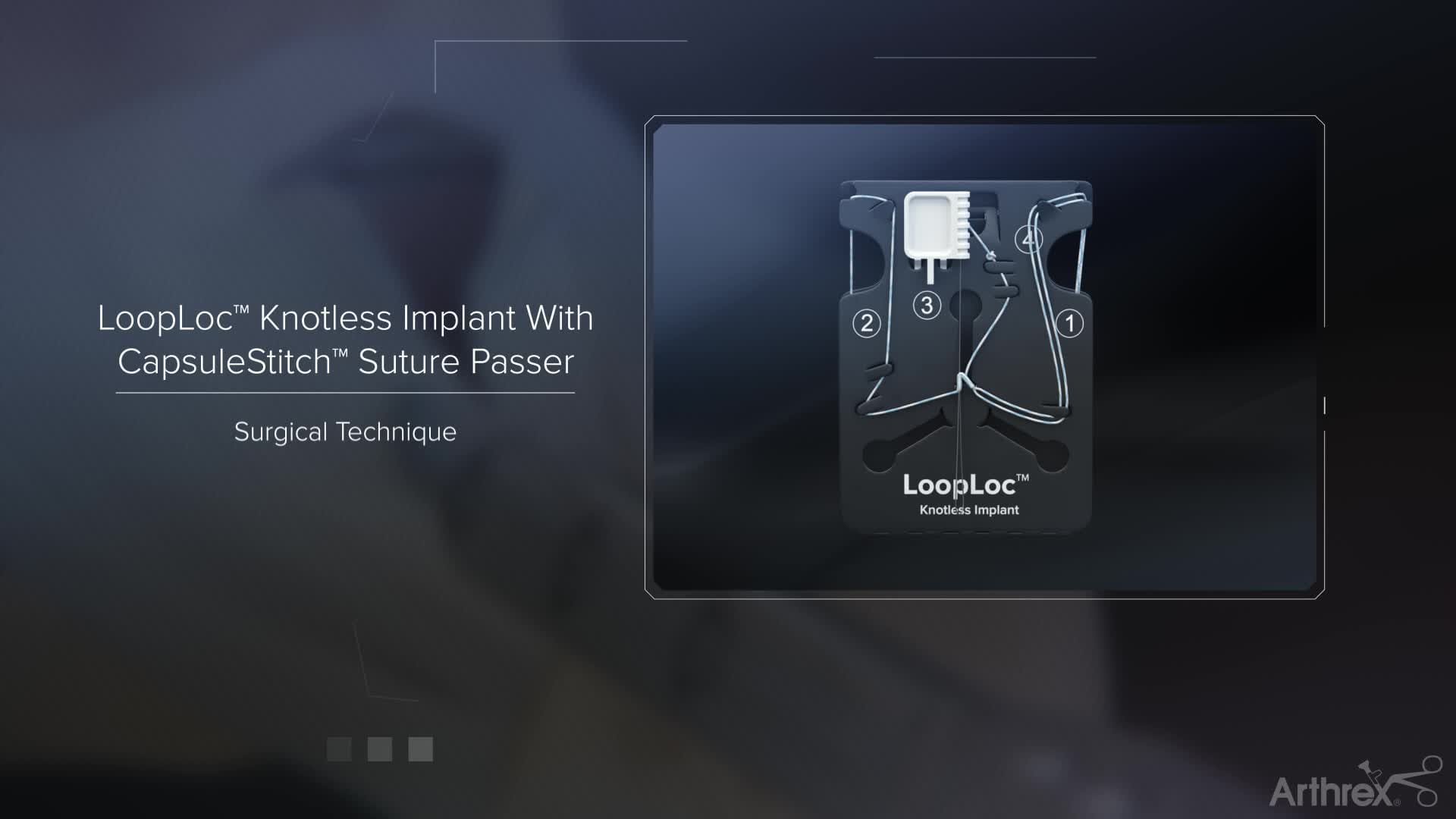 Arthrex - Hip Capsular Closure Using LoopLoc™ Knotless Implant