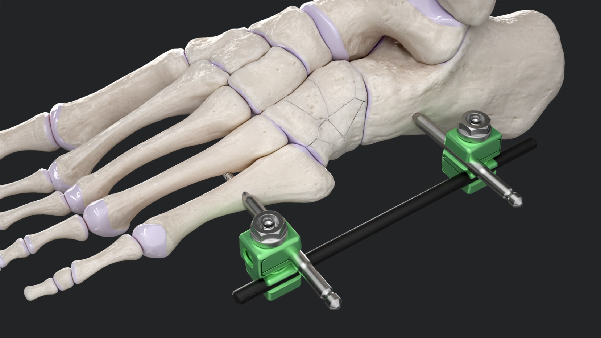 Arthrex - Small External Fixator