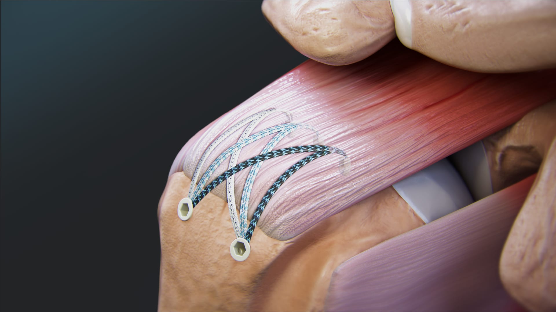 Arthrex - FiberTak® SpeedBridge™ Rotator Cuff Repair