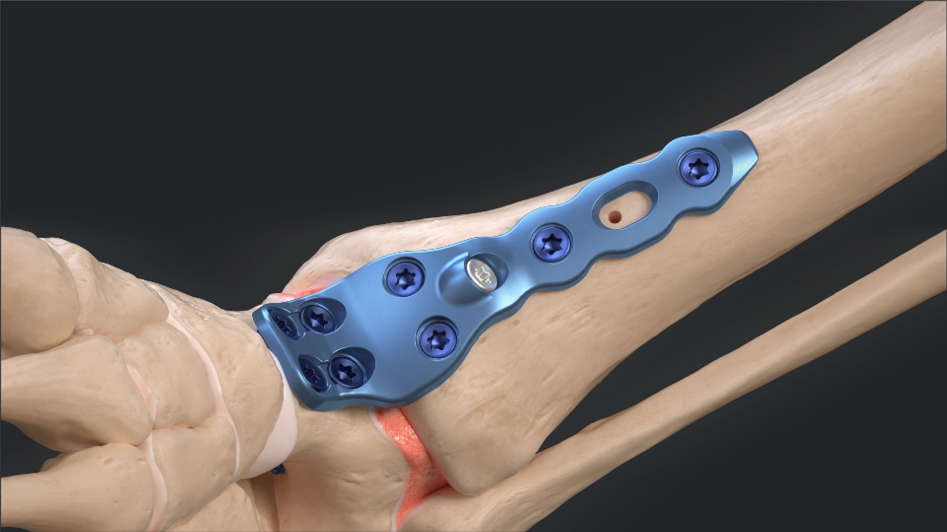Arthrex - Ankle Fusion Plating System