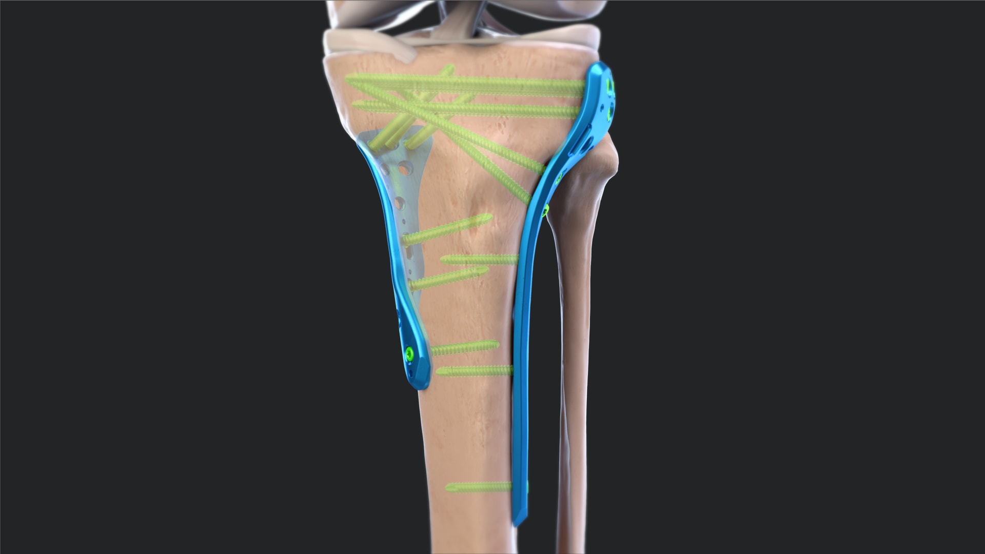 Arthrex - Proximal Tibial Plating System