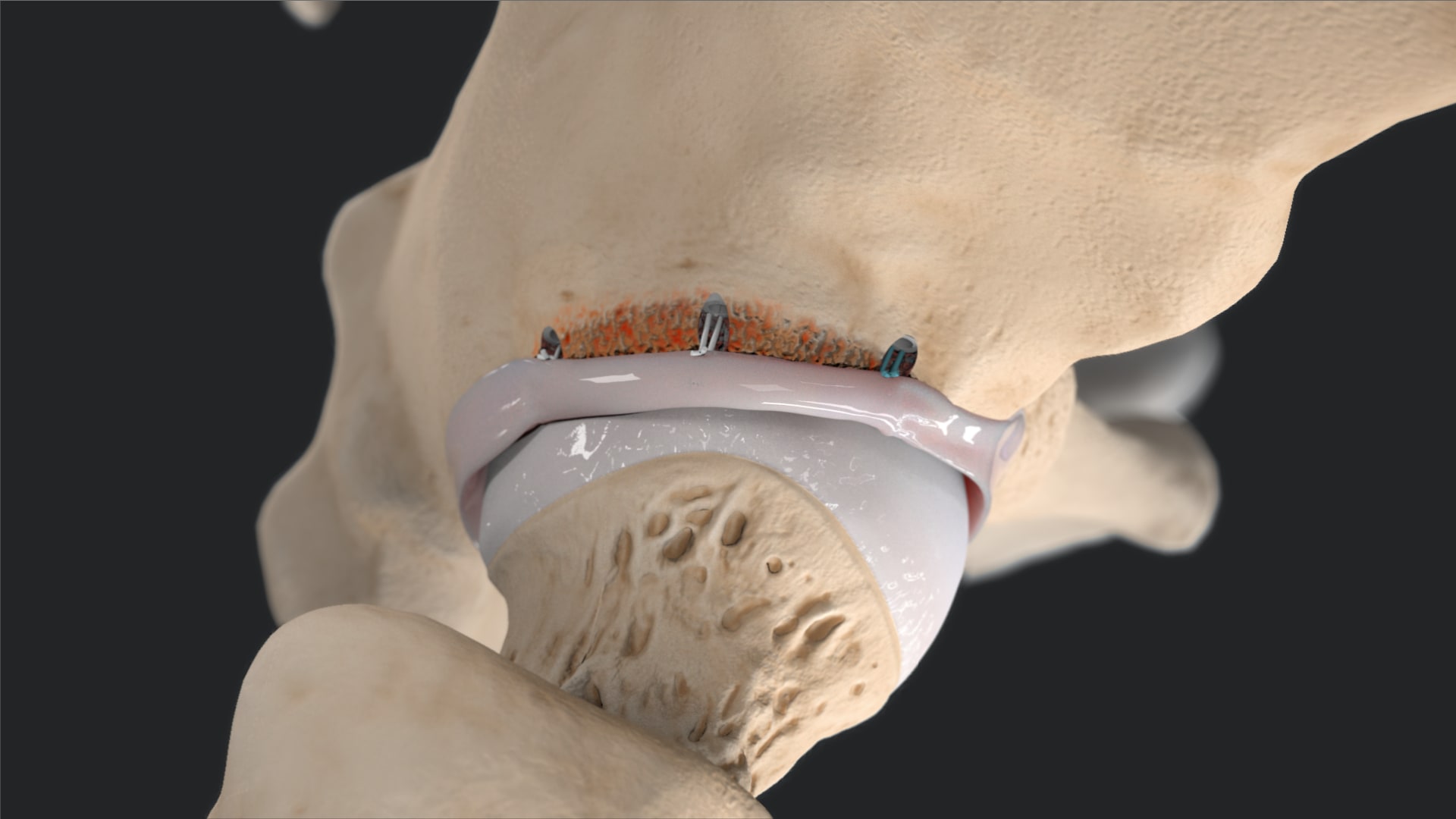 Arthrex - Hip Labral Reconstruction