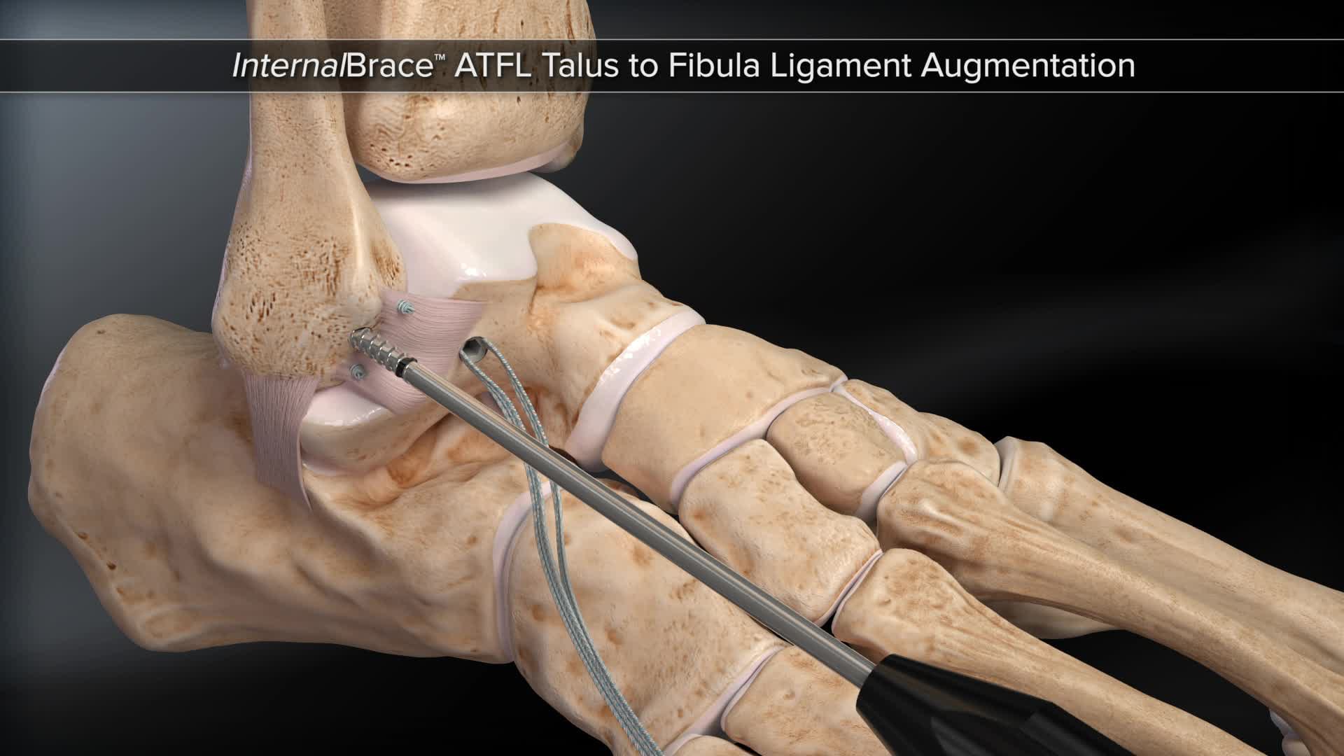 Arthrex - InternalBrace™ ATFL Talus to Fibula Ligament Augmentation