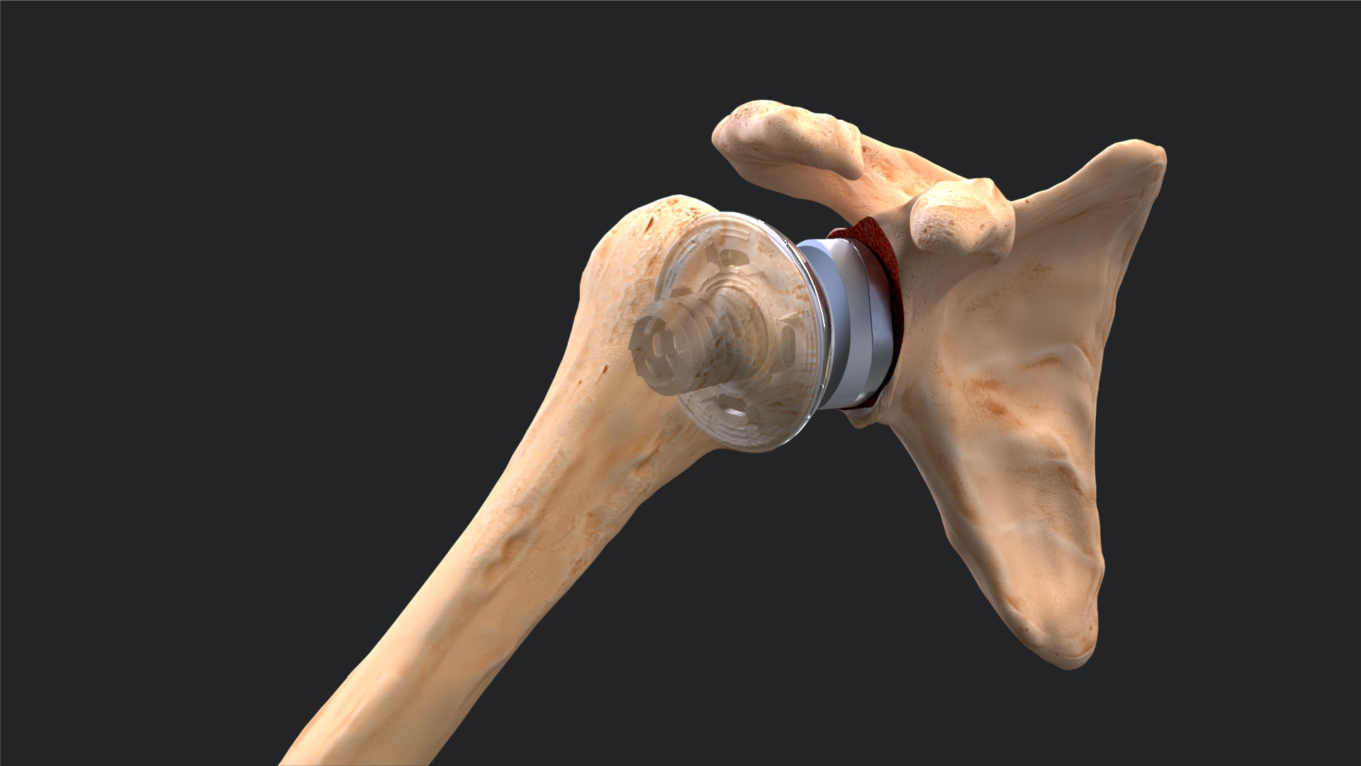 Arthrex - Univers Revers™-Schultertotalendoprothesensystem