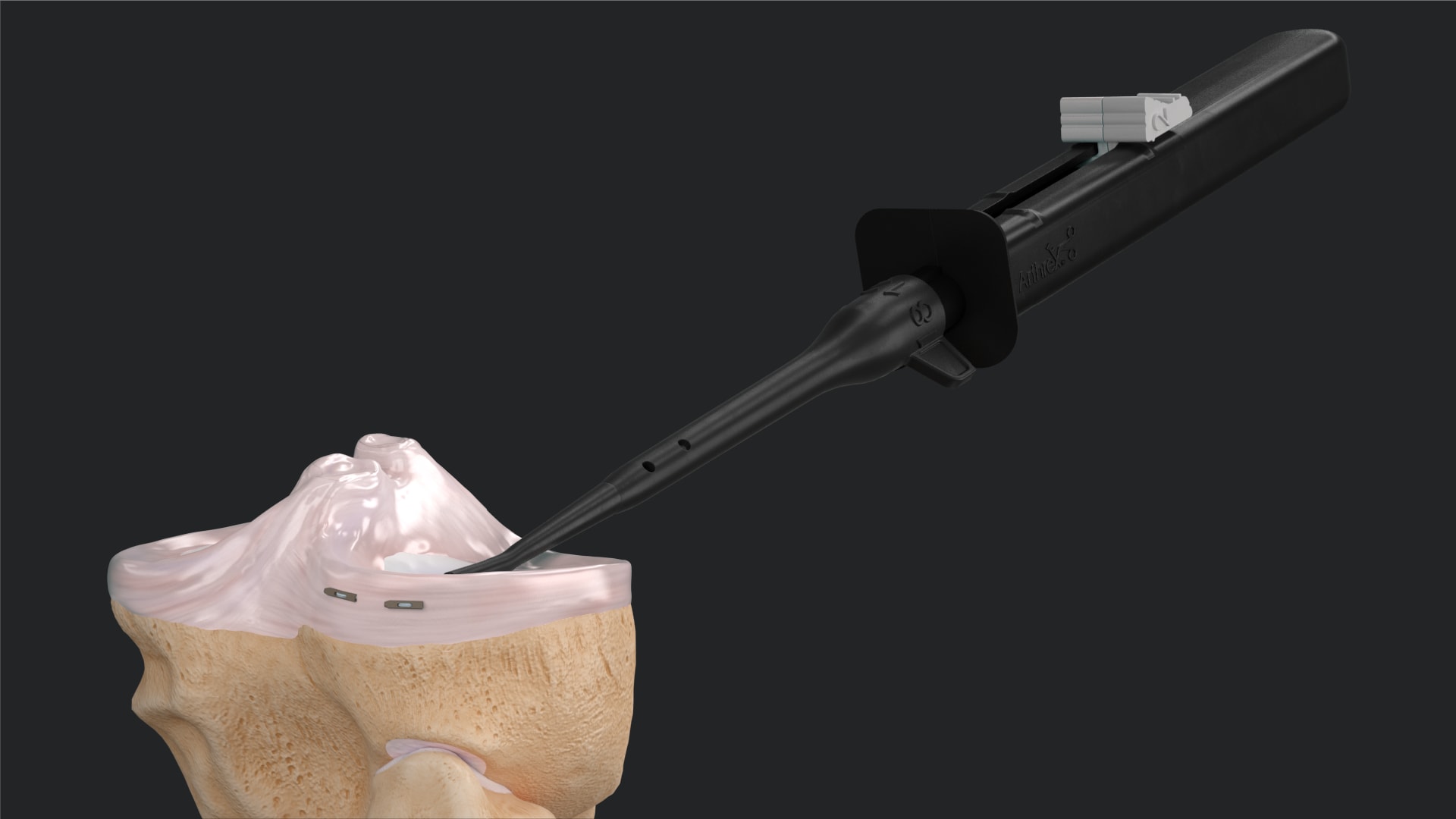 Arthrex - Meniscal Cinch™ II Device