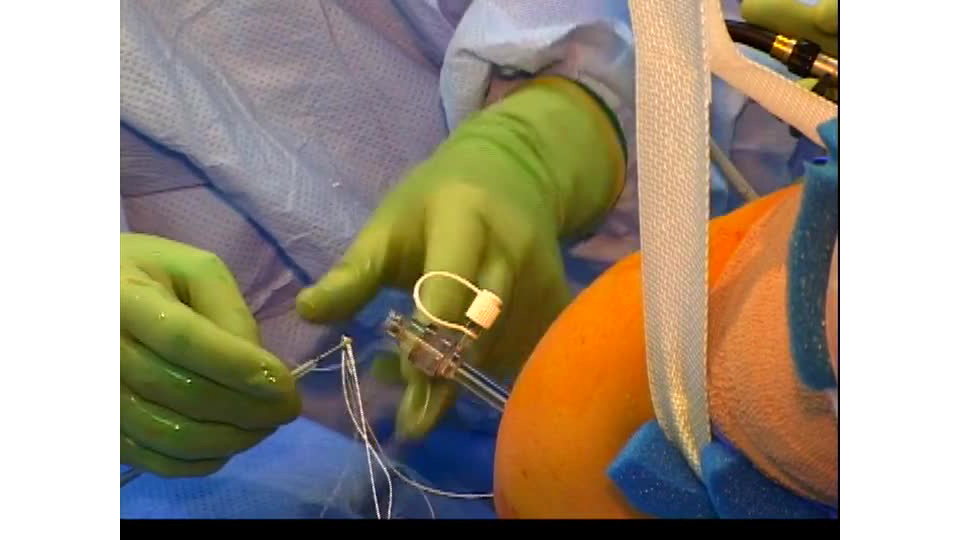 Arthrex - PushLock® Anchor