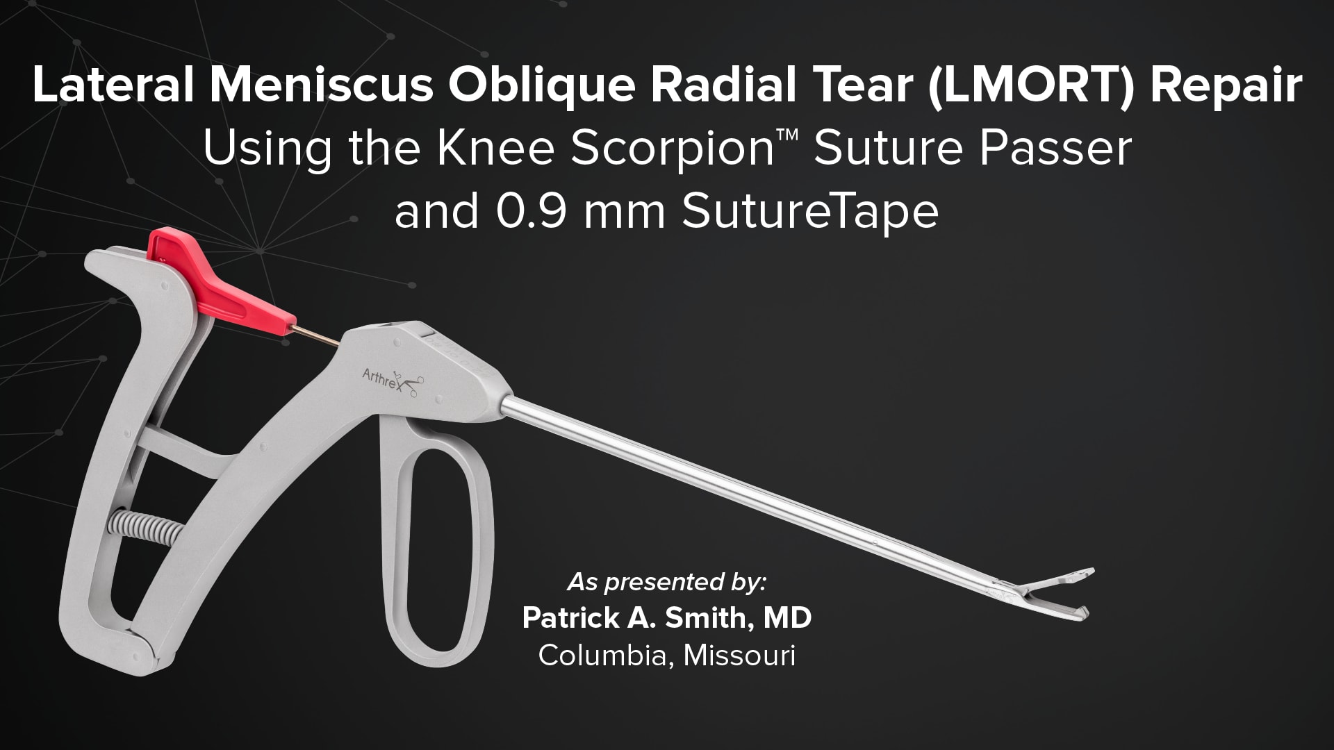 Arthrex - Lateral Meniscus Oblique Radial Tear (LMORT) Repair Using the ...