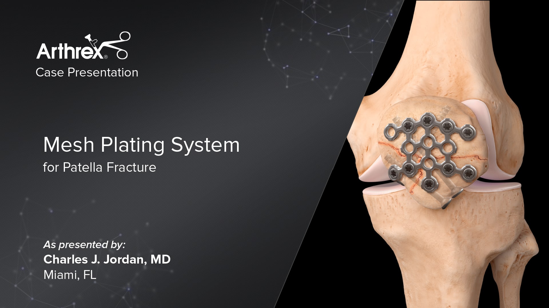 Arthrex - Mesh Plating System for Patella Fracture