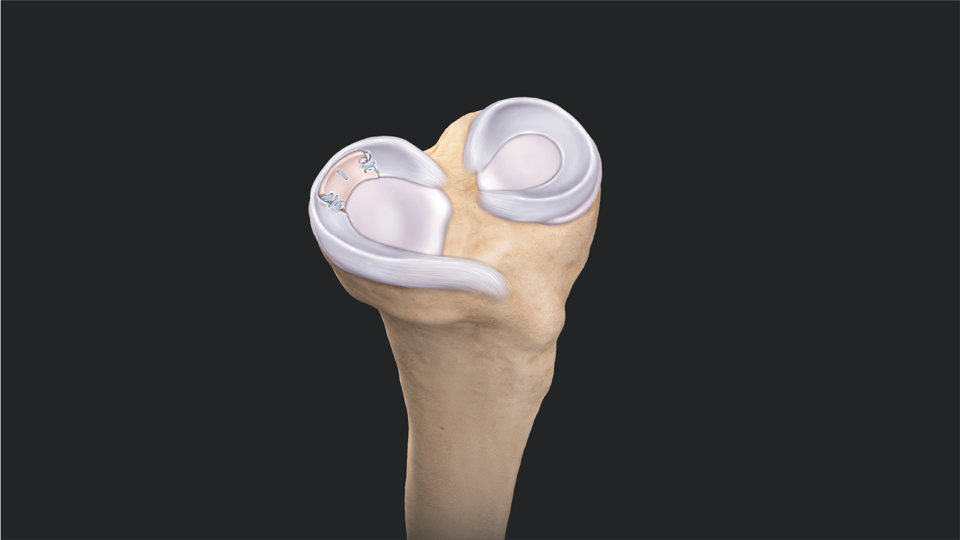 Arthrex - Segmental Meniscus Transplantation for Meniscal Repair and ...