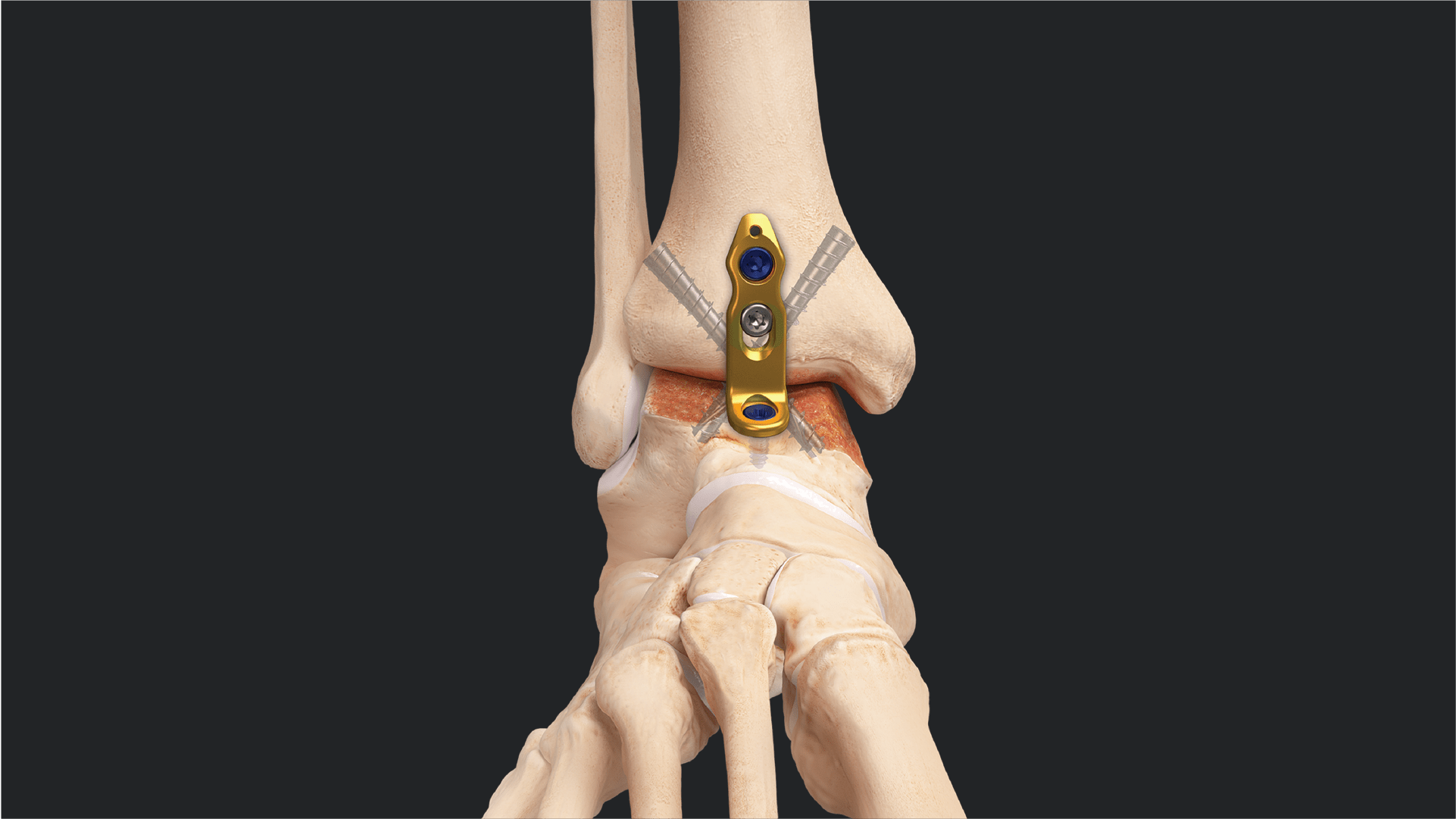 Arthrex - Plantar-Flexed Ankle Fusion Revision Using the Minimally ...