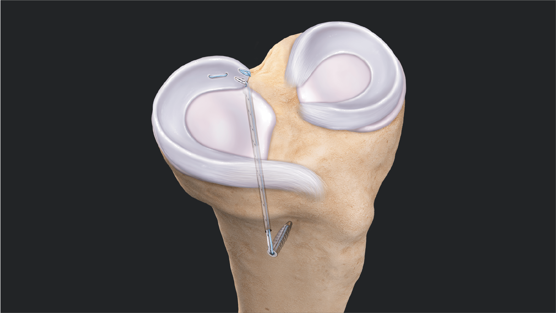 Arthrex - “Fix-and-Stitch” Augmented Posterior Meniscus Root Repair