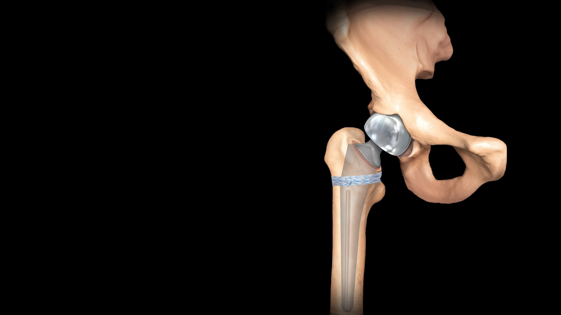 Arthrex - FiberTape® Cerclage: Lower Extremity Applications