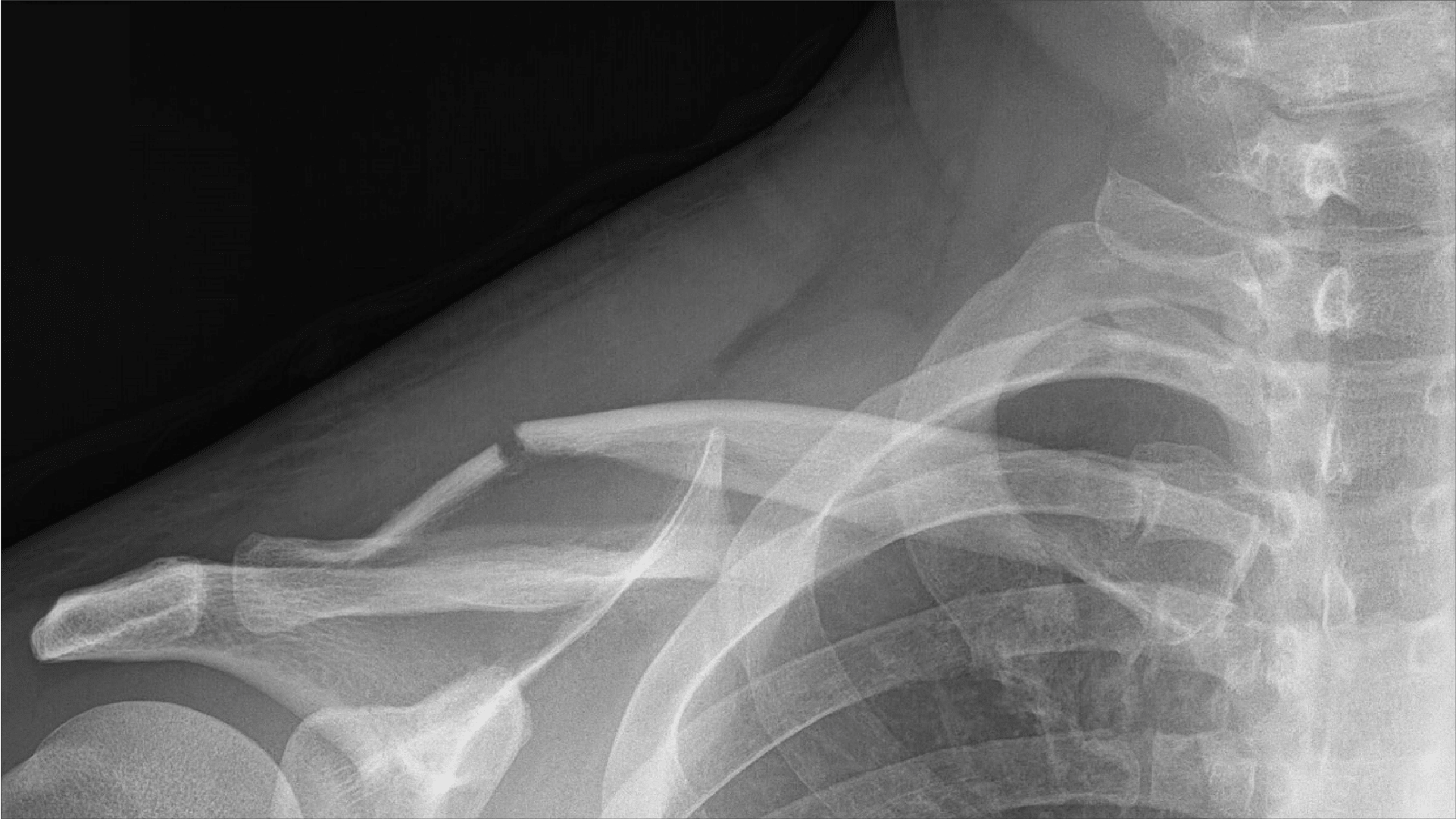 Arthrex - FiberTape® Cerclage