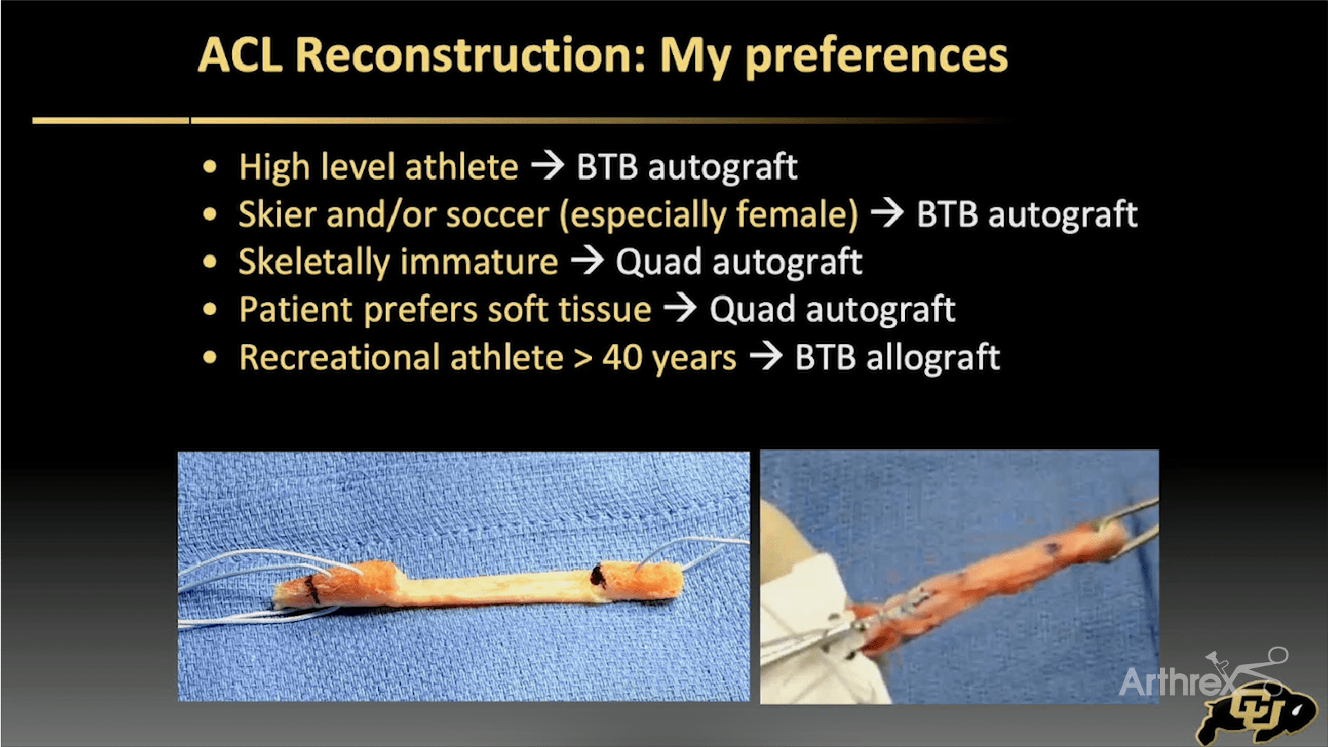 Arthrex - ACL Reconstruction: What Is My Graft of Choice?