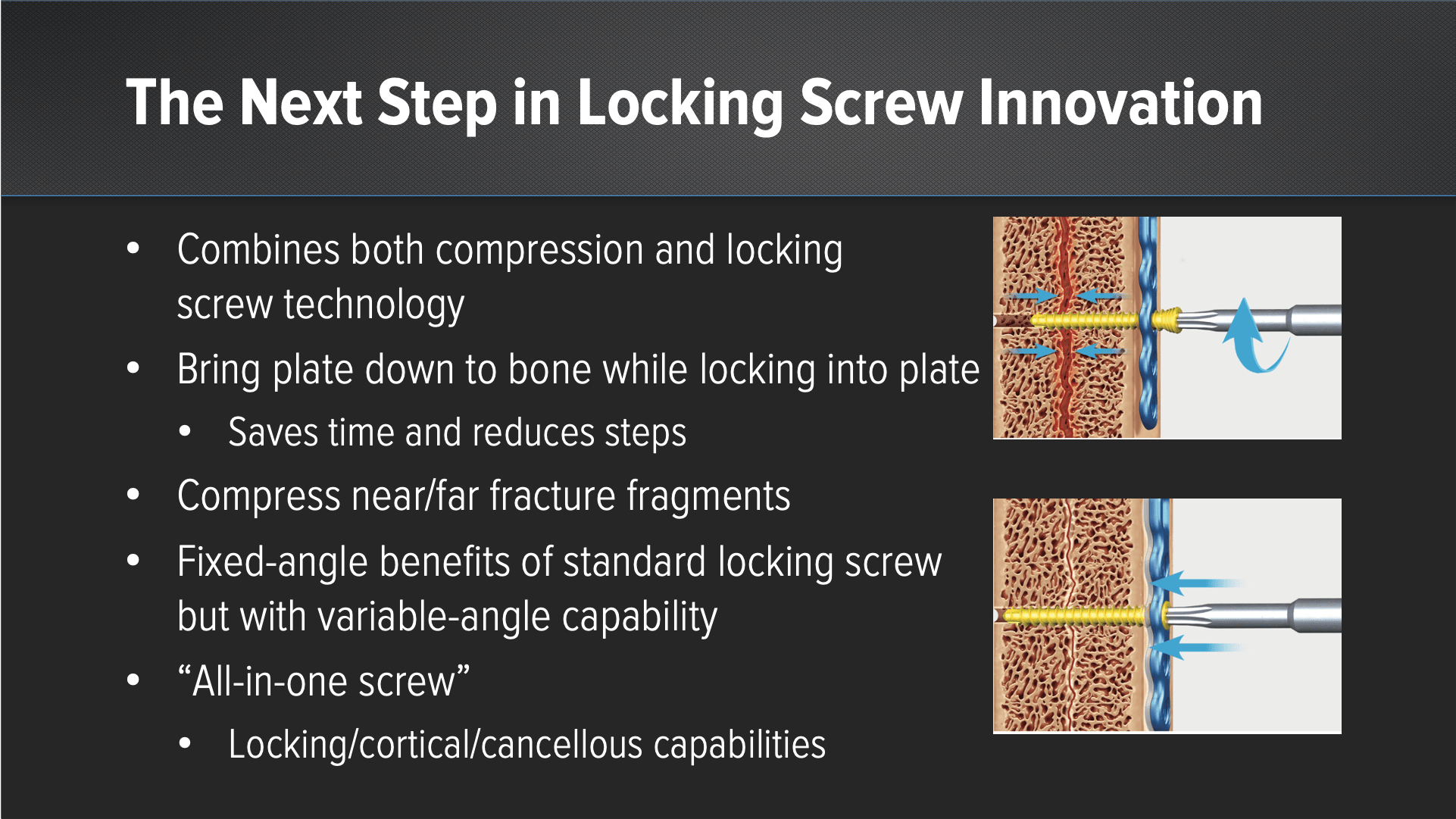 Arthrex - KreuLock™ Locking Compression Screws