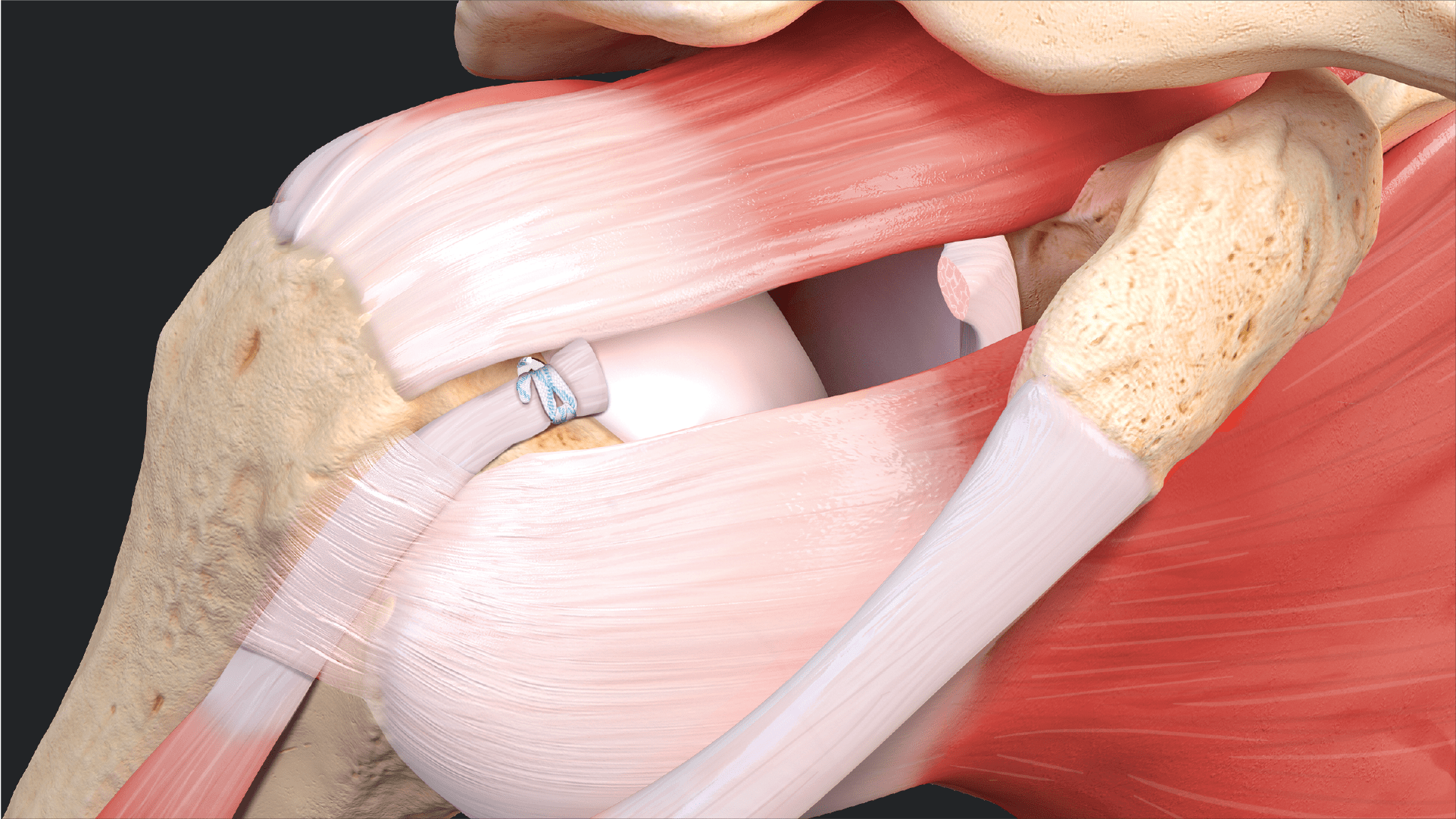 Arthrex - Proximal Biceps Tenodesis Using the Loop ‘N’ Tack™ Implant System