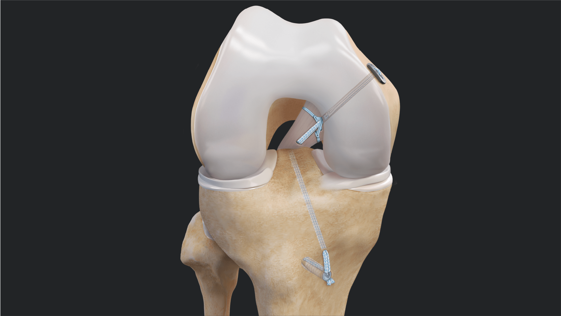 Arthrex - FiberRing™ Sutures