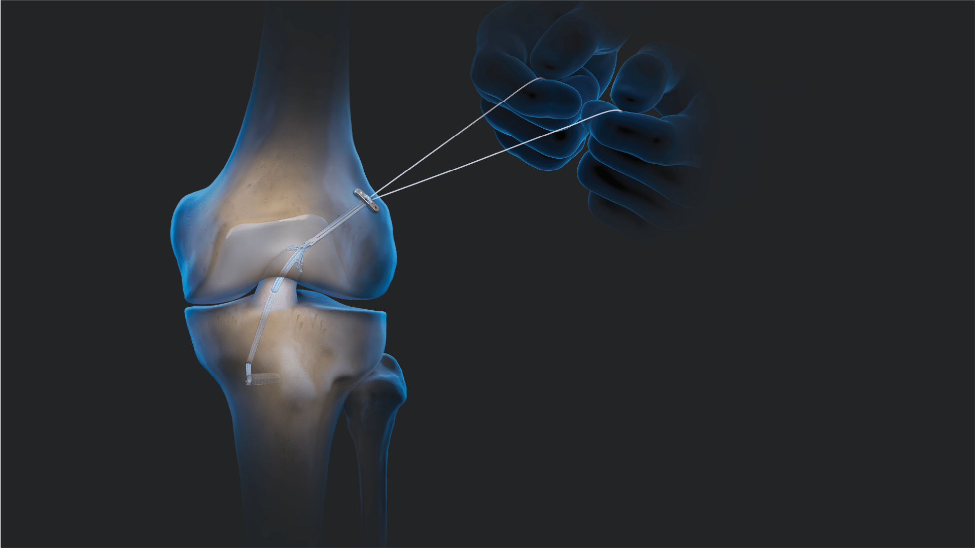 Arthrex - ACL Primary Repair Using the ACL Repair TightRope® Implant ...