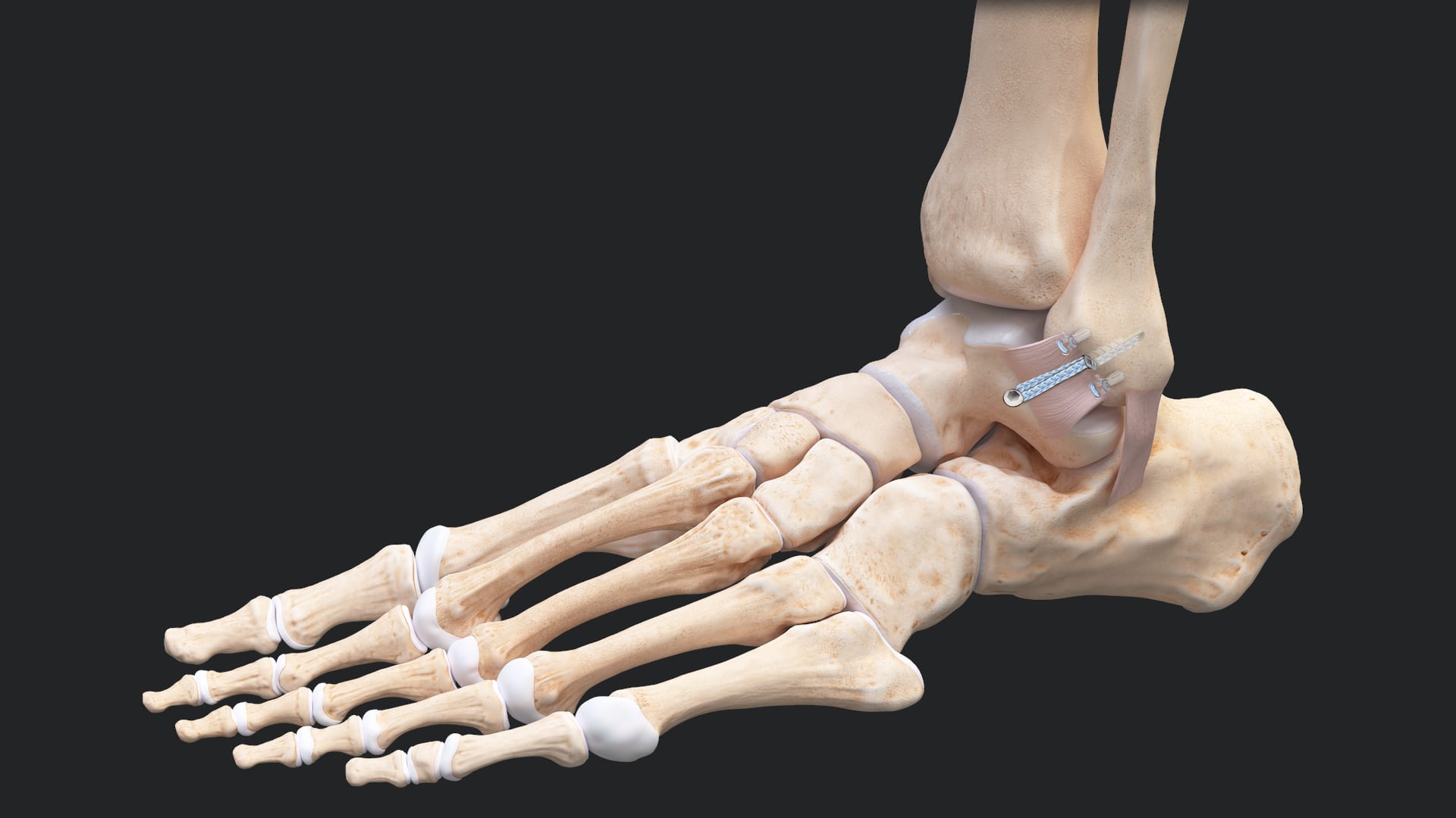 Arthrex - Knotless Brostrom Lateral Ankle Repair With InternalBrace ...