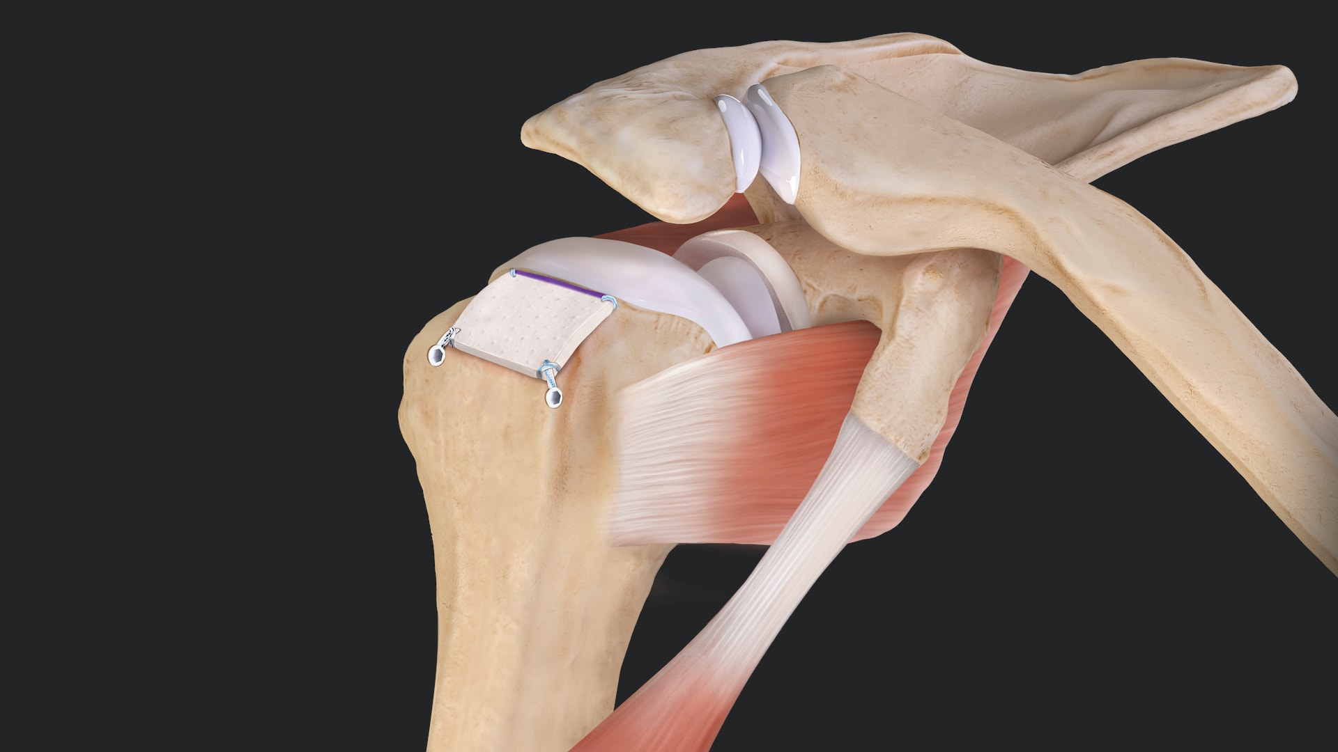 Arthrex - Biologic Tuberoplasty Technique