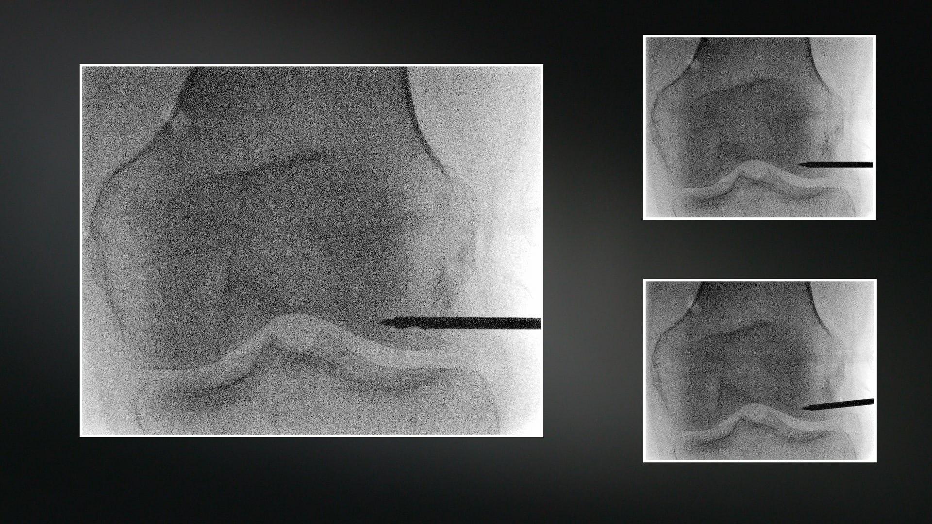 Arthrex - IntraOsseous BioPlasty® Technique in Clinic