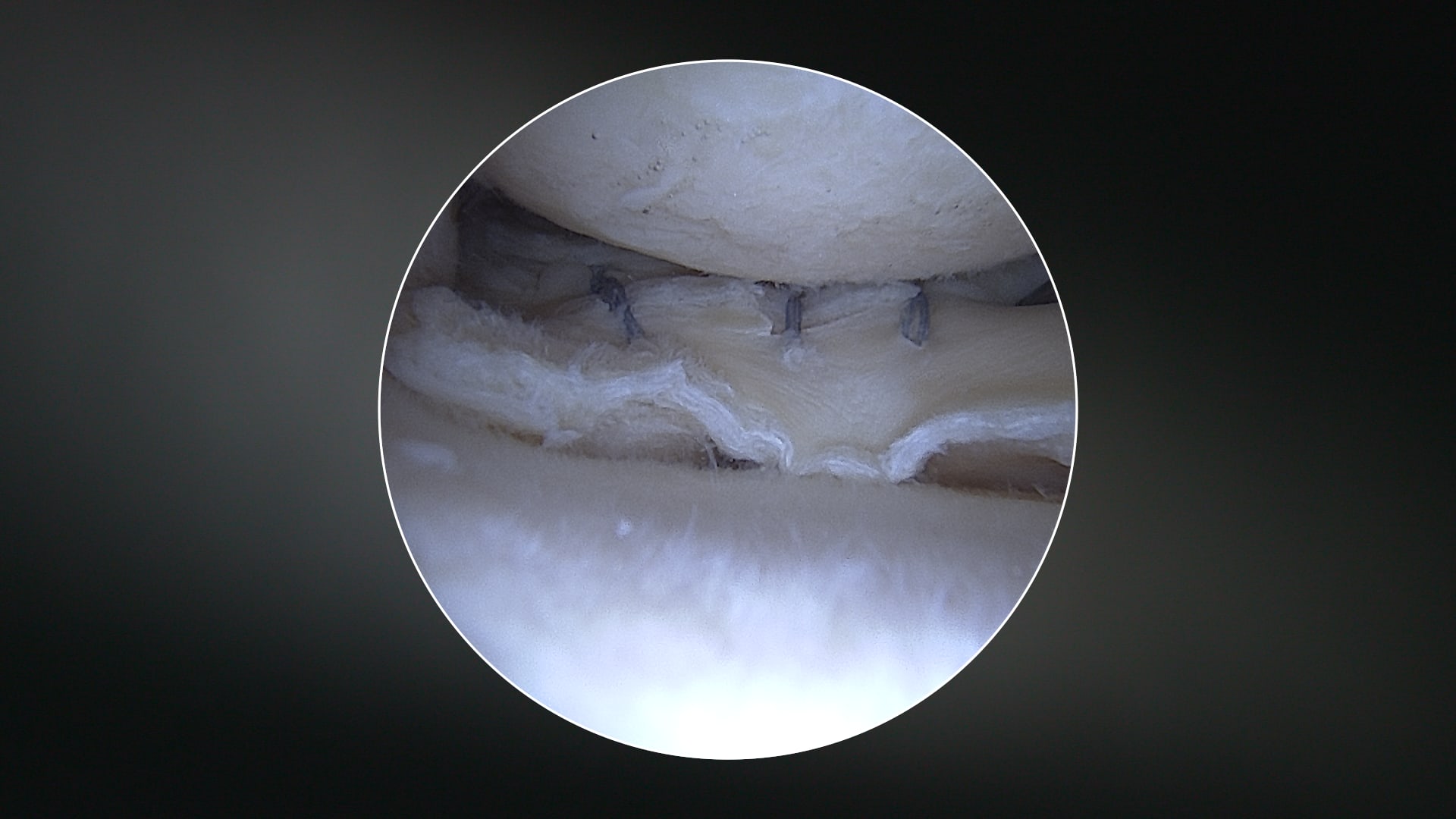 Arthrex - Sequential All-Inside Meniscal Reduction Using the All-Suture ...