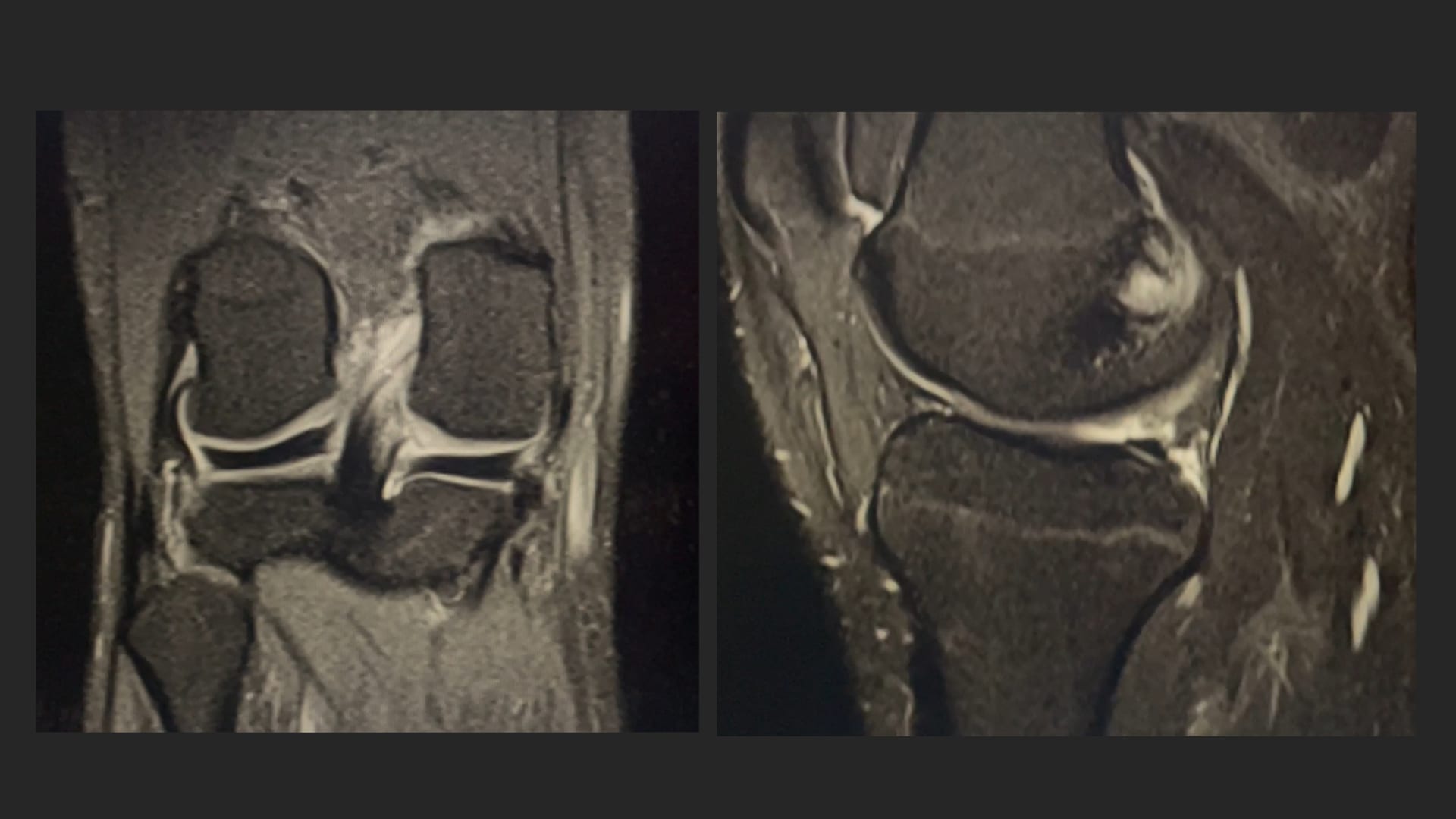 Arthrex - All-Inside Longitudinal Medial Meniscus Repair Using the ...
