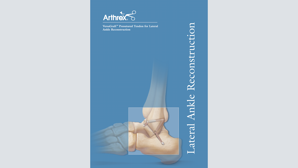 Arthrex - Lateral Ankle Ligament Reconstruction