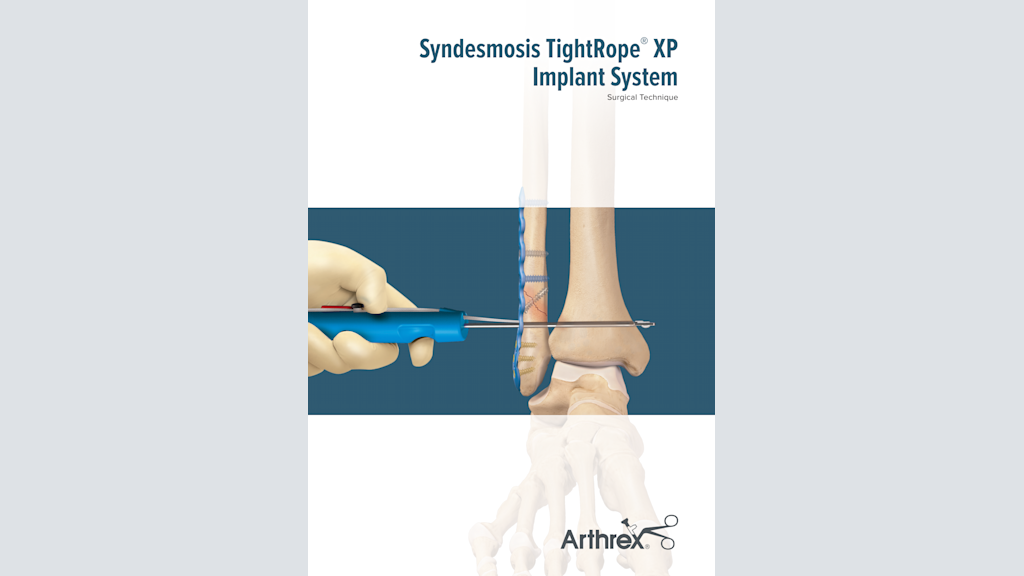 Arthrex - Syndesmosis TightRope® XP Implant System