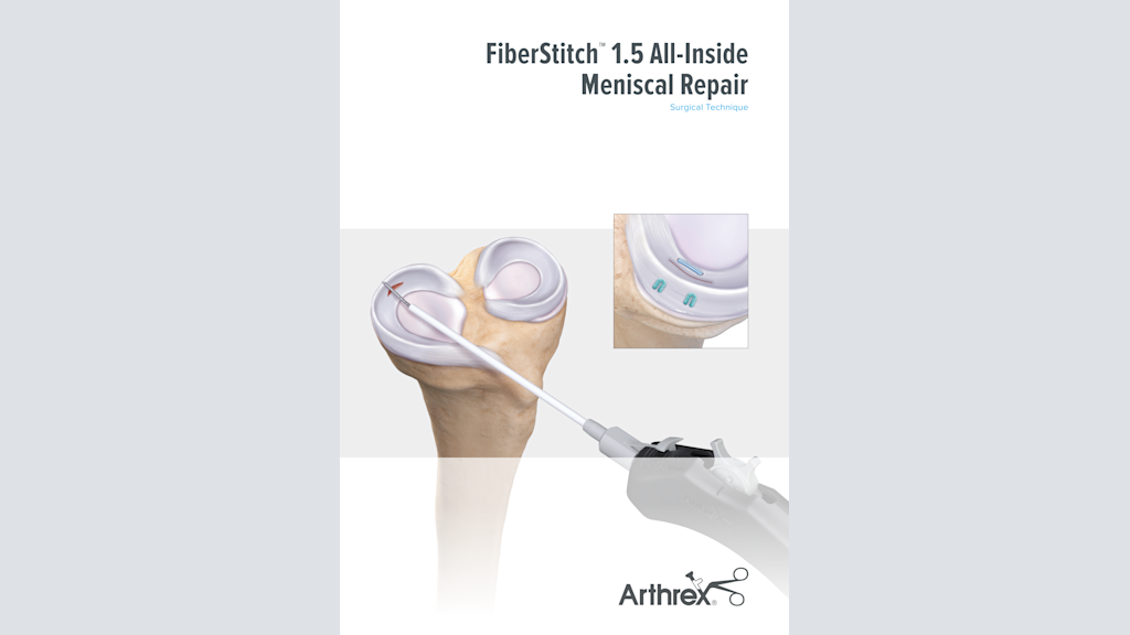 Arthrex - FiberStitch™ 1.5 Implant