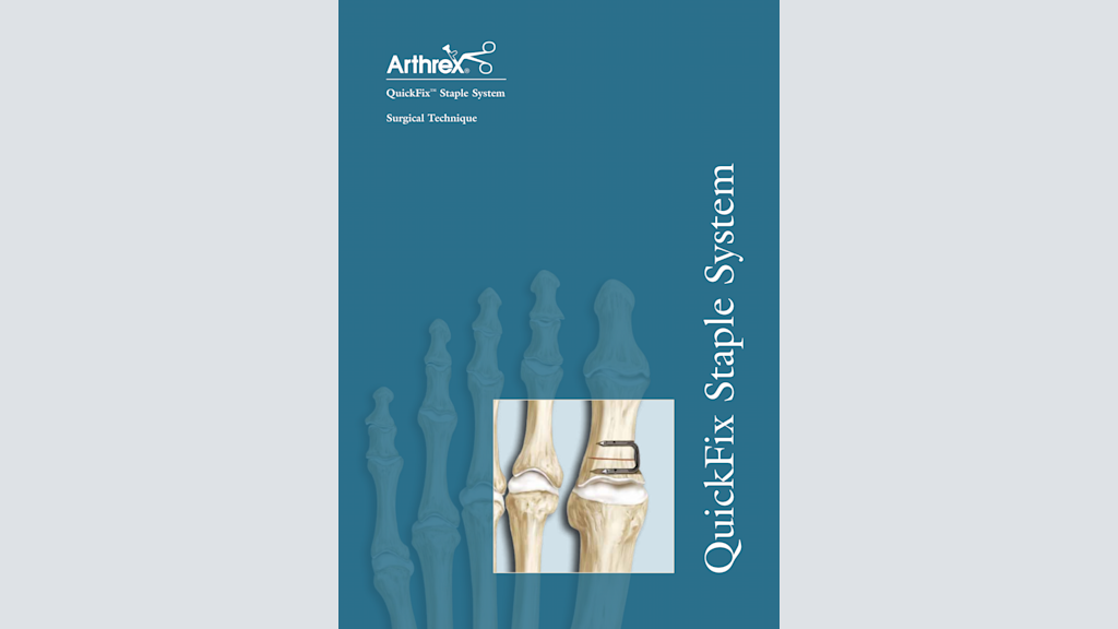 Arthrex - QuickFix™ Staple System