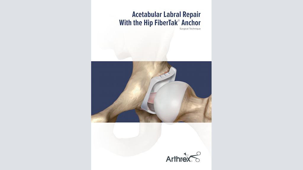 Arthrex - Labral Fixation