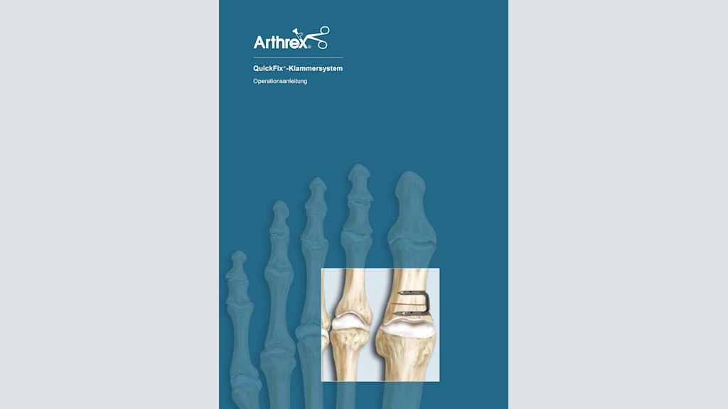 Arthrex - QuickFix™ Staple System