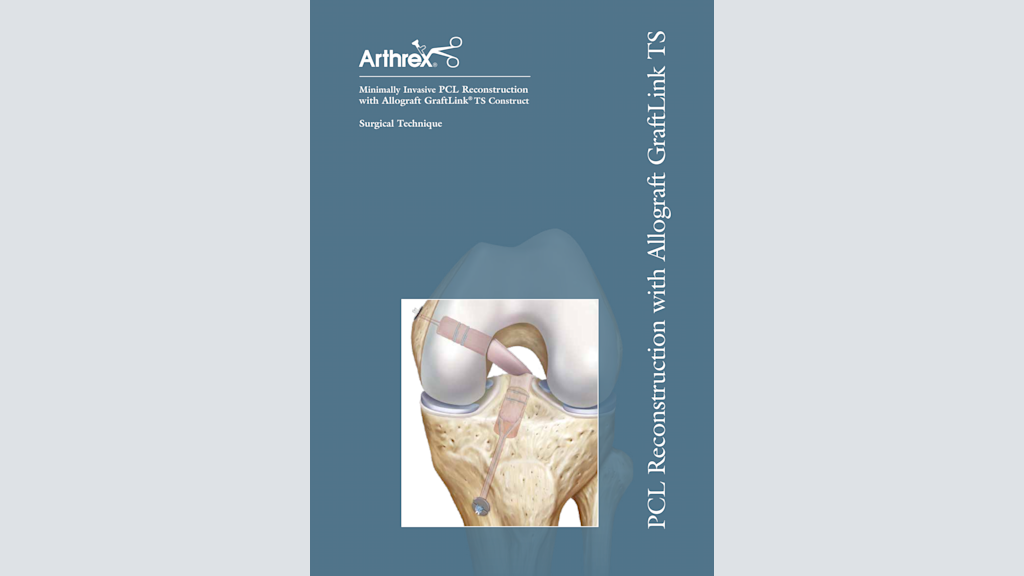 Arthrex - Allograft ACL Reconstruction