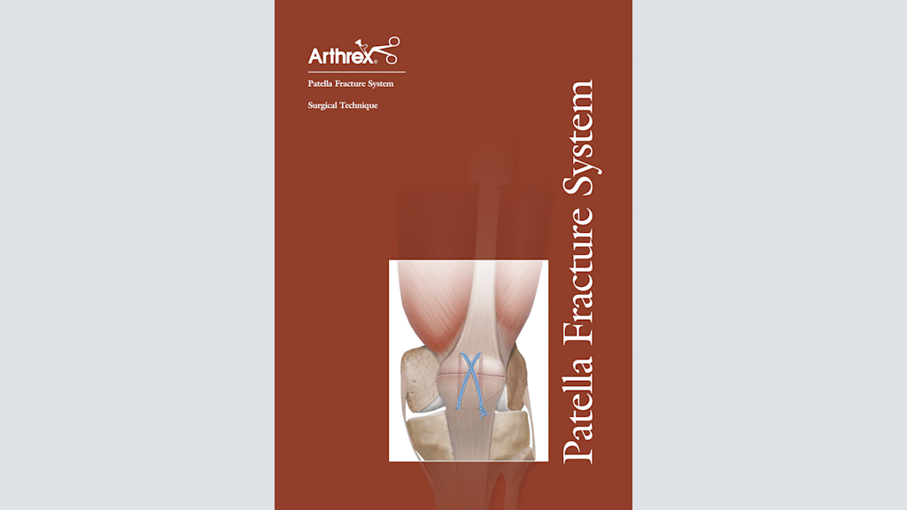 Arthrex - Patella Fracture System